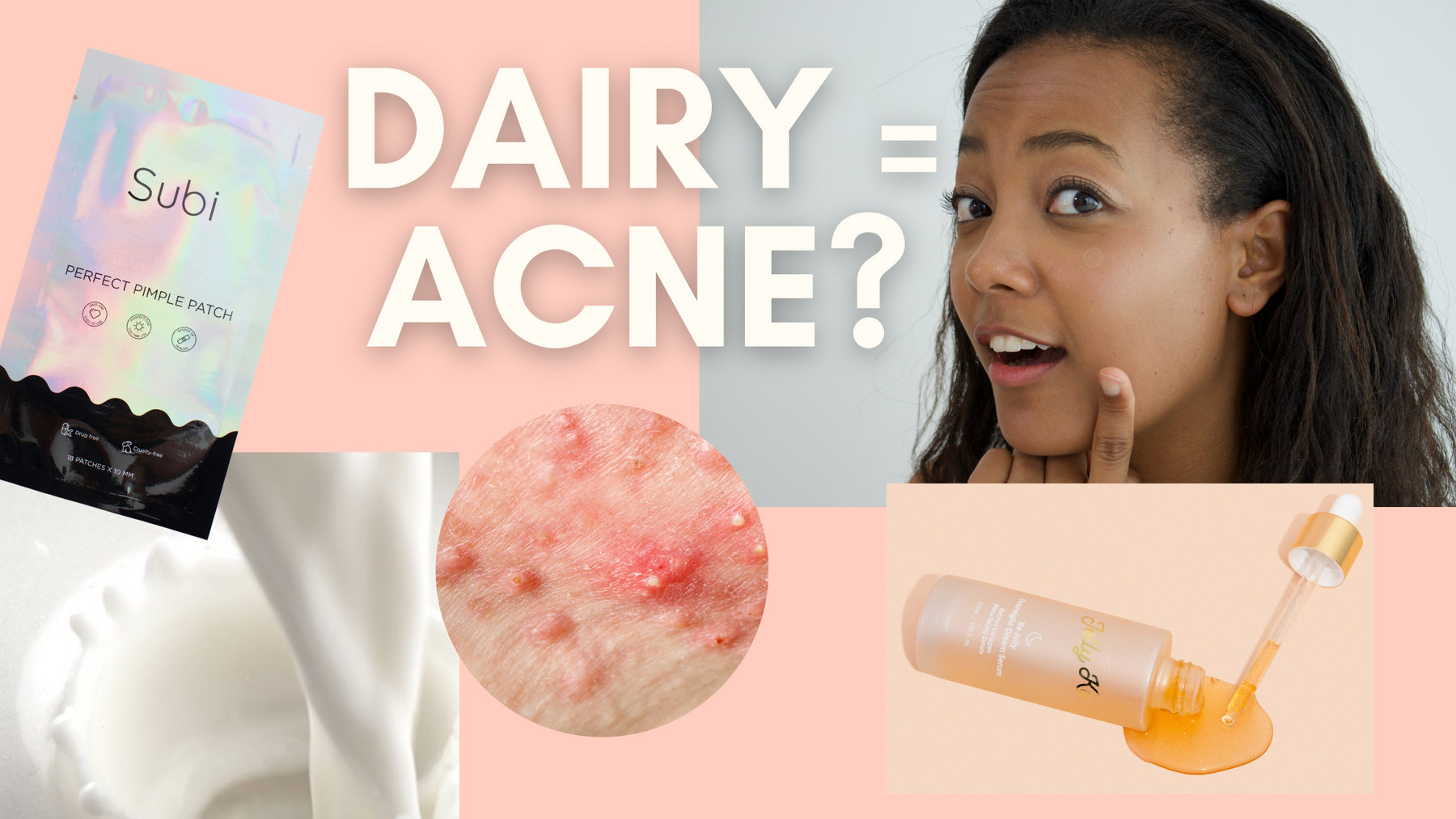 Does Dairy Cause Acne? - STYLE STORY
